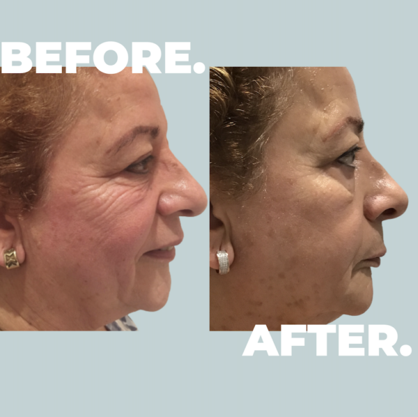 BLACK FRIDAY - HIFU Full Face (Forehead, Eyes & Cheeks) Single ...