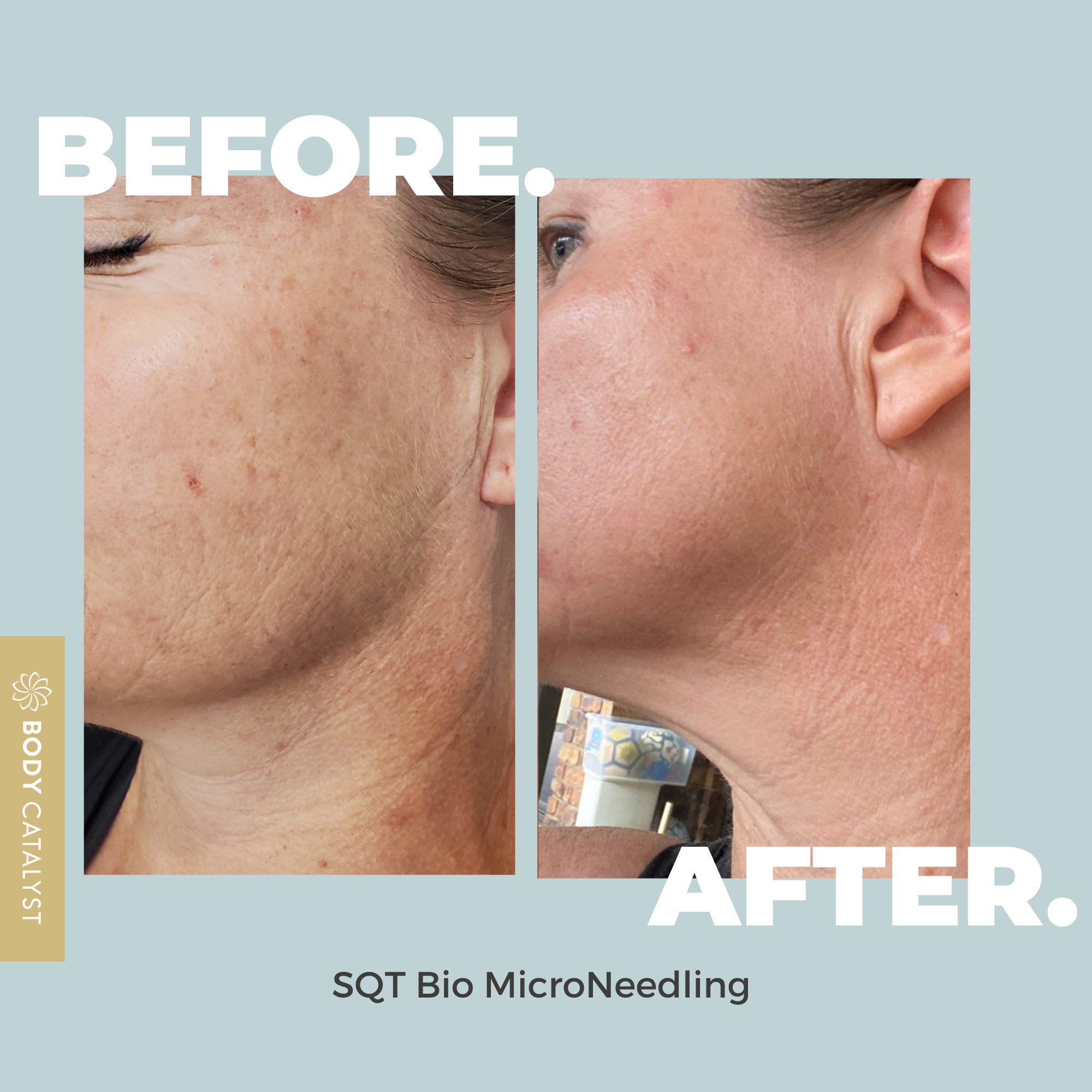 Sun Spot Removal with SQT Bio-Microneedling | Body Catalyst